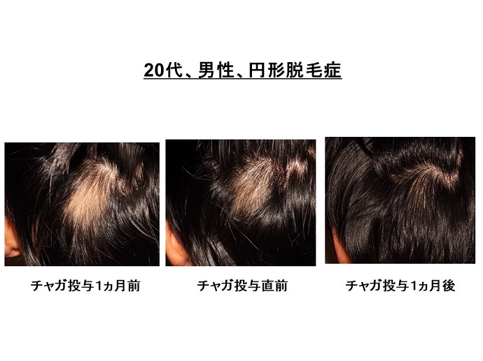 チャガを加えて、円形脱毛症、ほぼ、完治！ 患者様からの声・メディア掲載・クリニックからのお知らせ 名古屋kクリニック
